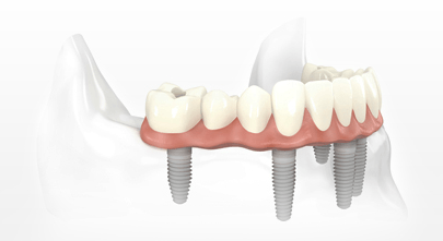 Implantología | Oralcorp | Servicios Dentales en Loja